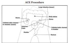 Antegrade Continence Enema Procedure