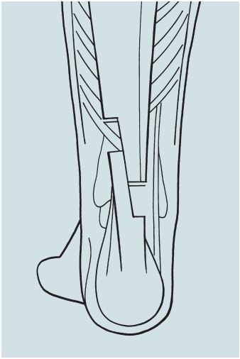 Single-Event Multilevel Surgery (SEMLS) Procedures