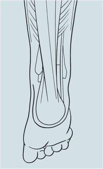 Single-Event Multilevel Surgery (SEMLS) Procedures