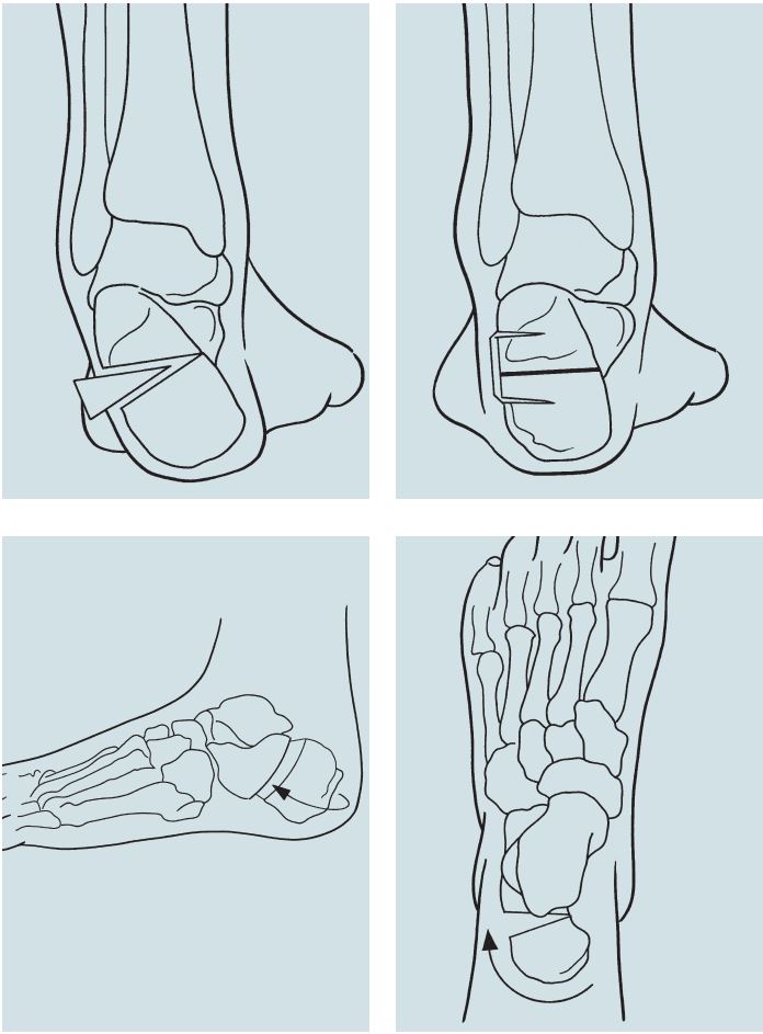 Single-Event Multilevel Surgery (SEMLS) Procedures