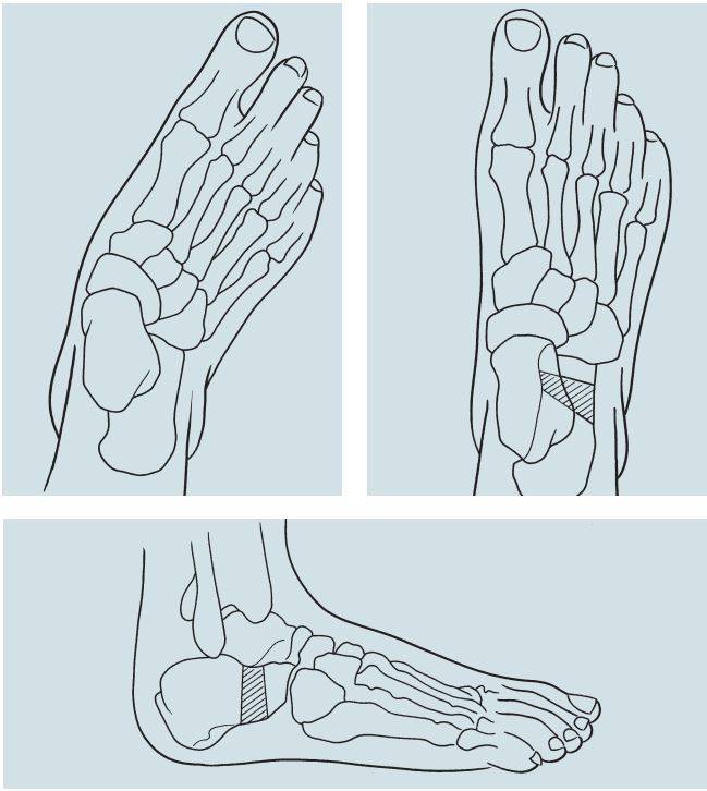 Single-Event Multilevel Surgery (SEMLS) Procedures