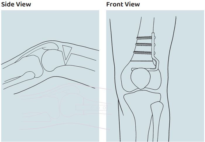 Single-Event Multilevel Surgery (SEMLS) Procedures