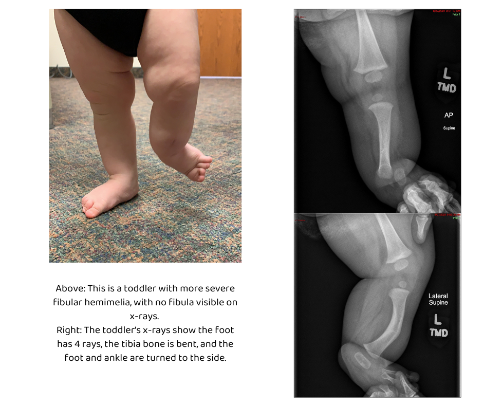 Fibular Hemimelia or Fibular Deficiency