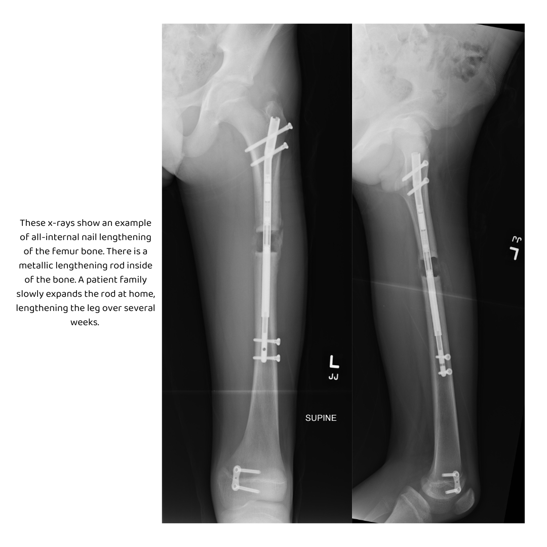 Fibular Hemimelia or Fibular Deficiency
