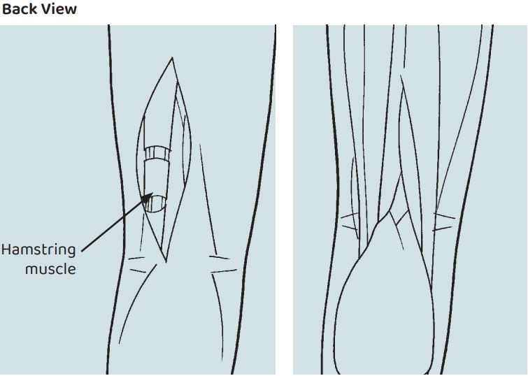 Single-Event Multilevel Surgery (SEMLS) Procedures
