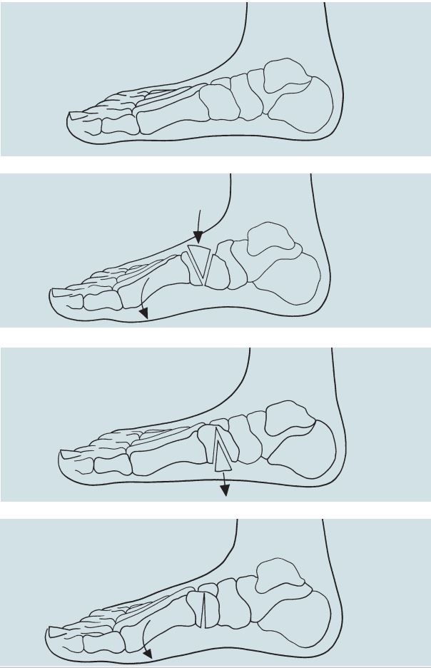 Single-Event Multilevel Surgery (SEMLS) Procedures