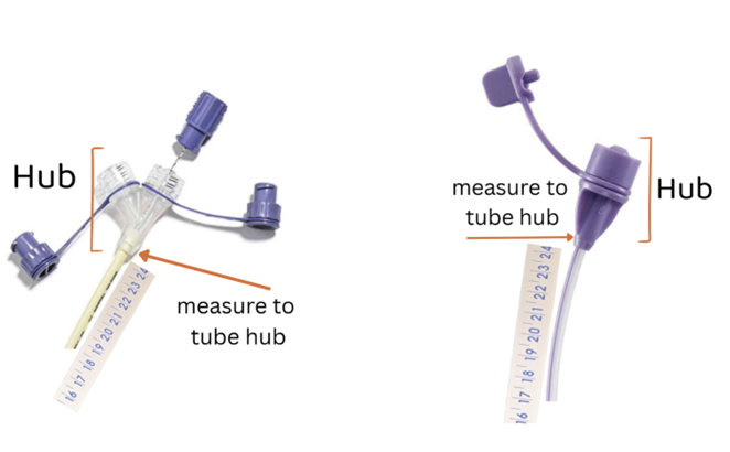 Nasogastric (NG) Tubes