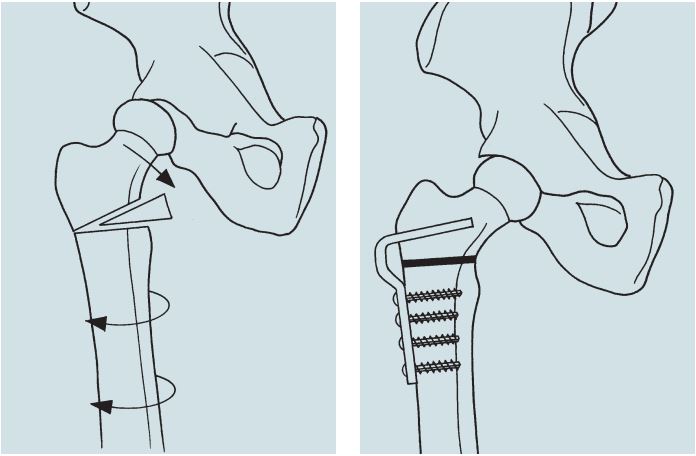 Single-Event Multilevel Surgery (SEMLS) Procedures