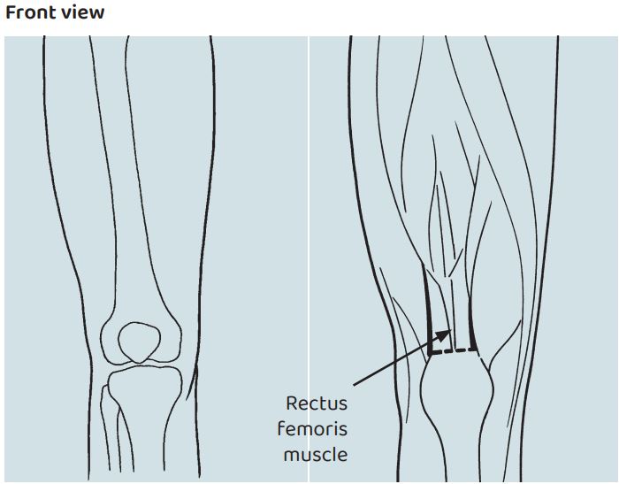 Single-Event Multilevel Surgery (SEMLS) Procedures