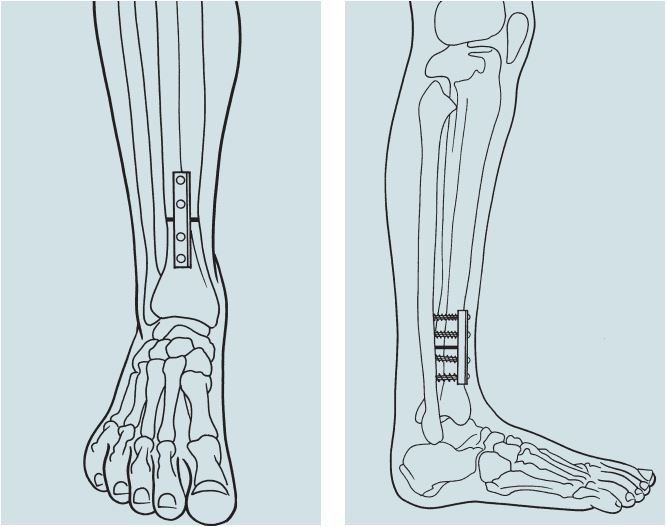 Single-Event Multilevel Surgery (SEMLS) Procedures