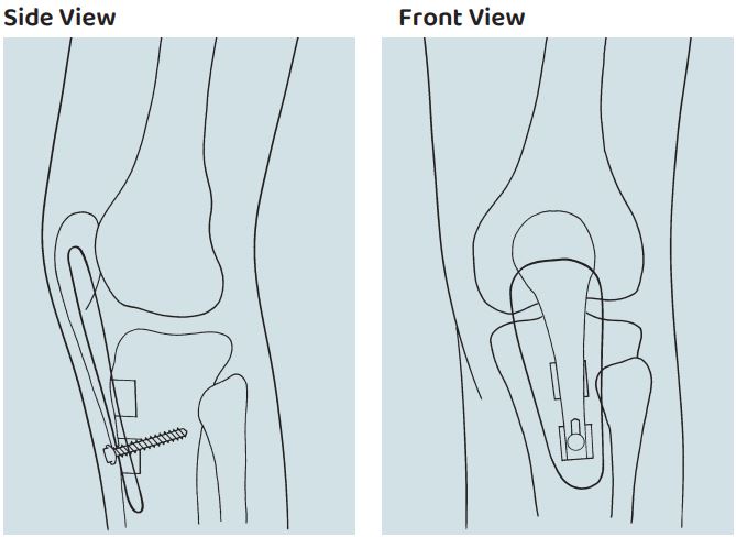Single-Event Multilevel Surgery (SEMLS) Procedures