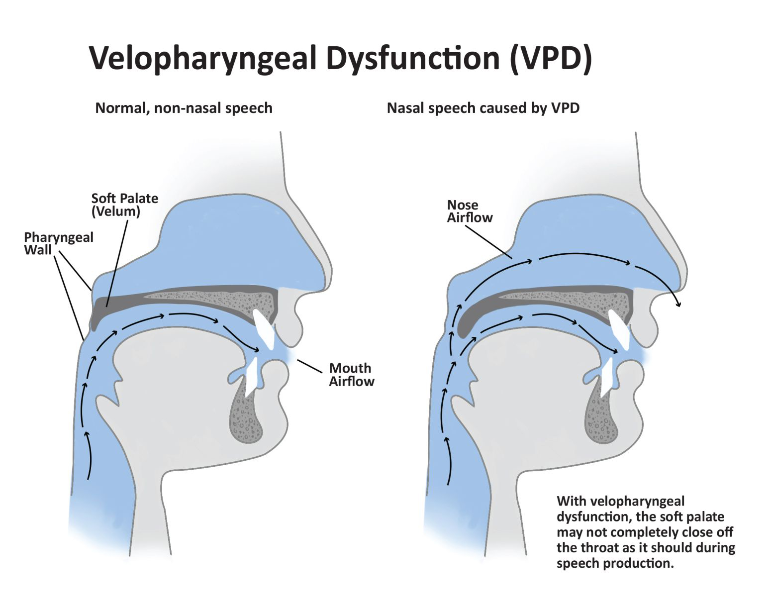 Velopharyngeal Dysfunction (VPD): Diagnosis, Treatment