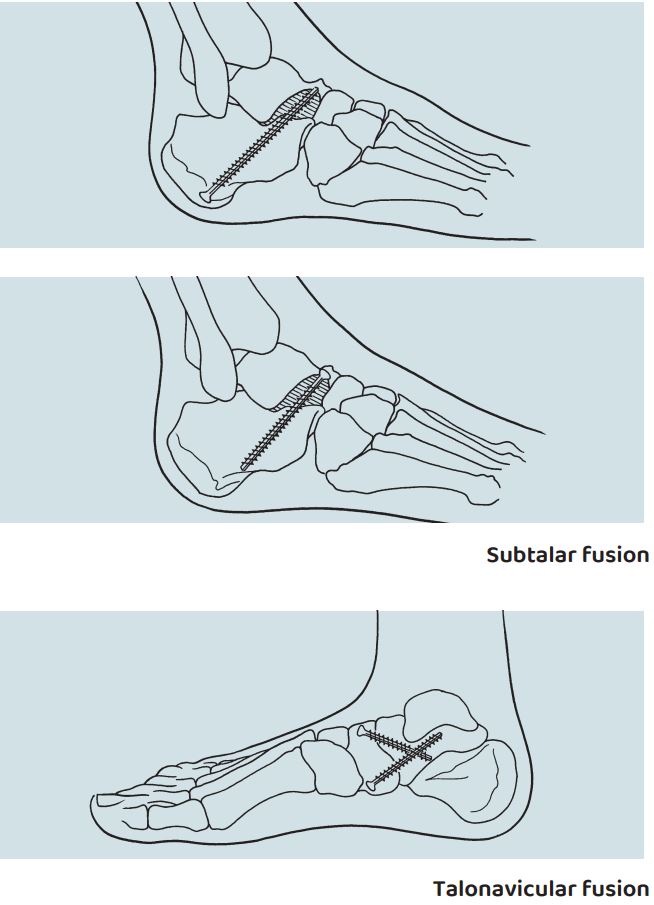 Single-Event Multilevel Surgery (SEMLS) Procedures