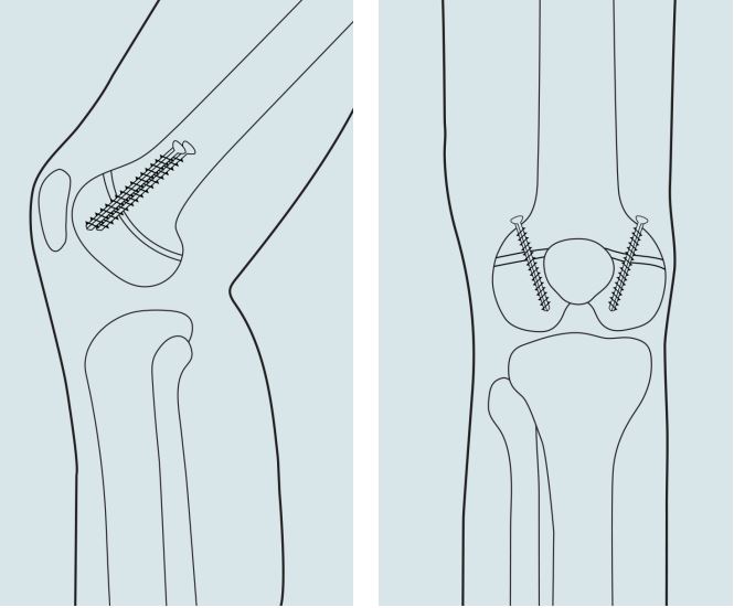 Single-Event Multilevel Surgery (SEMLS) Procedures