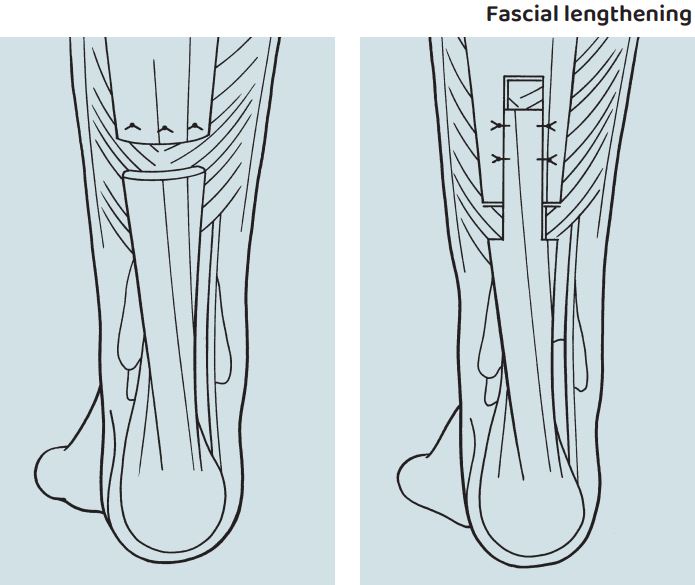 Single-Event Multilevel Surgery (SEMLS) Procedures