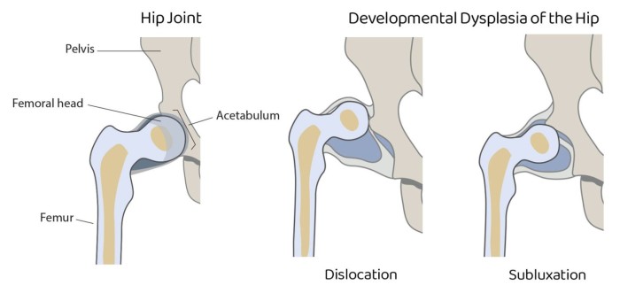 Developmental Dysplasia of the Hip (DDH)