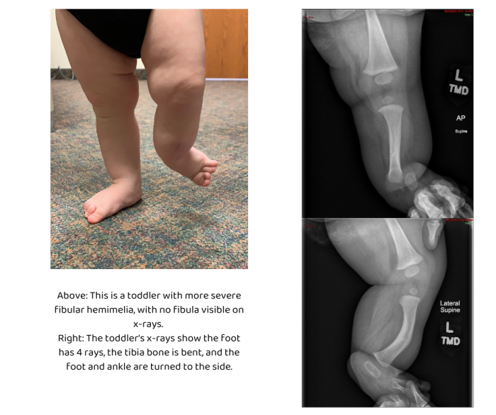 Fibular Hemimelia or Fibular Deficiency