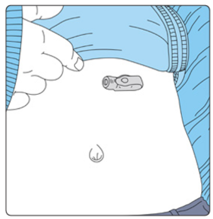What is a Gastrostomy Tube (G-Tube)?