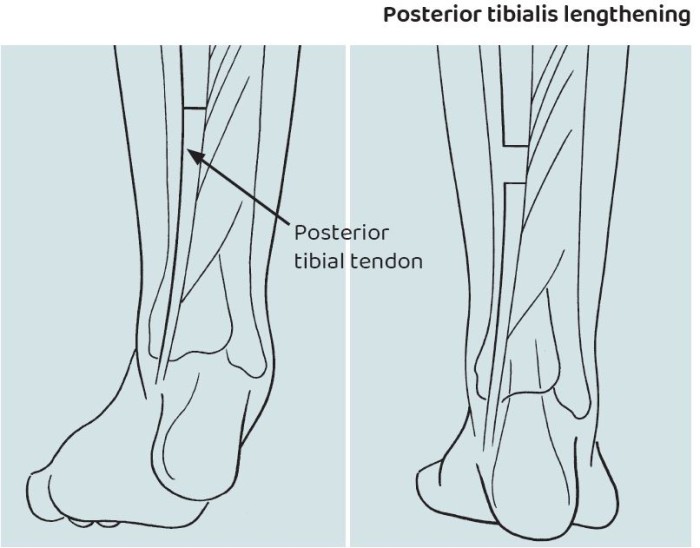 Single-Event Multilevel Surgery (SEMLS) Procedures