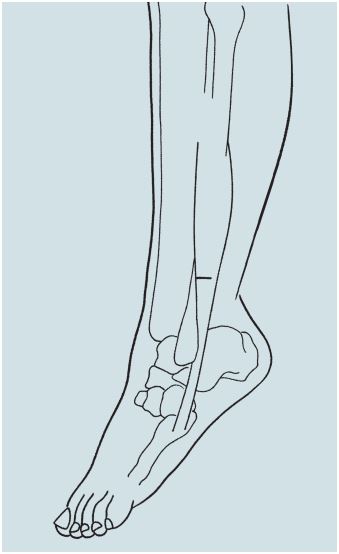 Single-Event Multilevel Surgery (SEMLS) Procedures