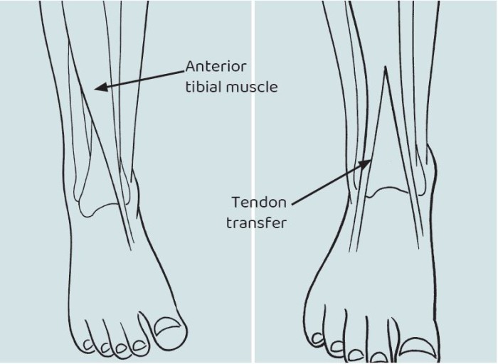 Single-Event Multilevel Surgery (SEMLS) Procedures