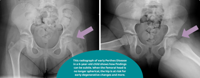 A Quick Guide to Perthes with Jennifer Laine, MD | Gillette Children's