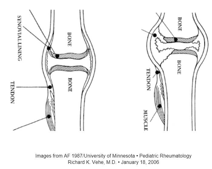 What Is Pediatric Arthritis?