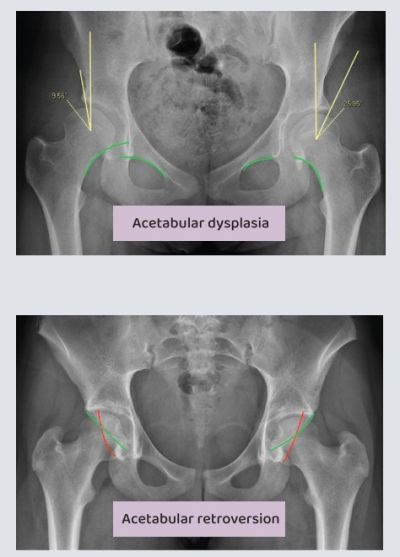 Periarticular Injections Improve Mobility After Surgery
